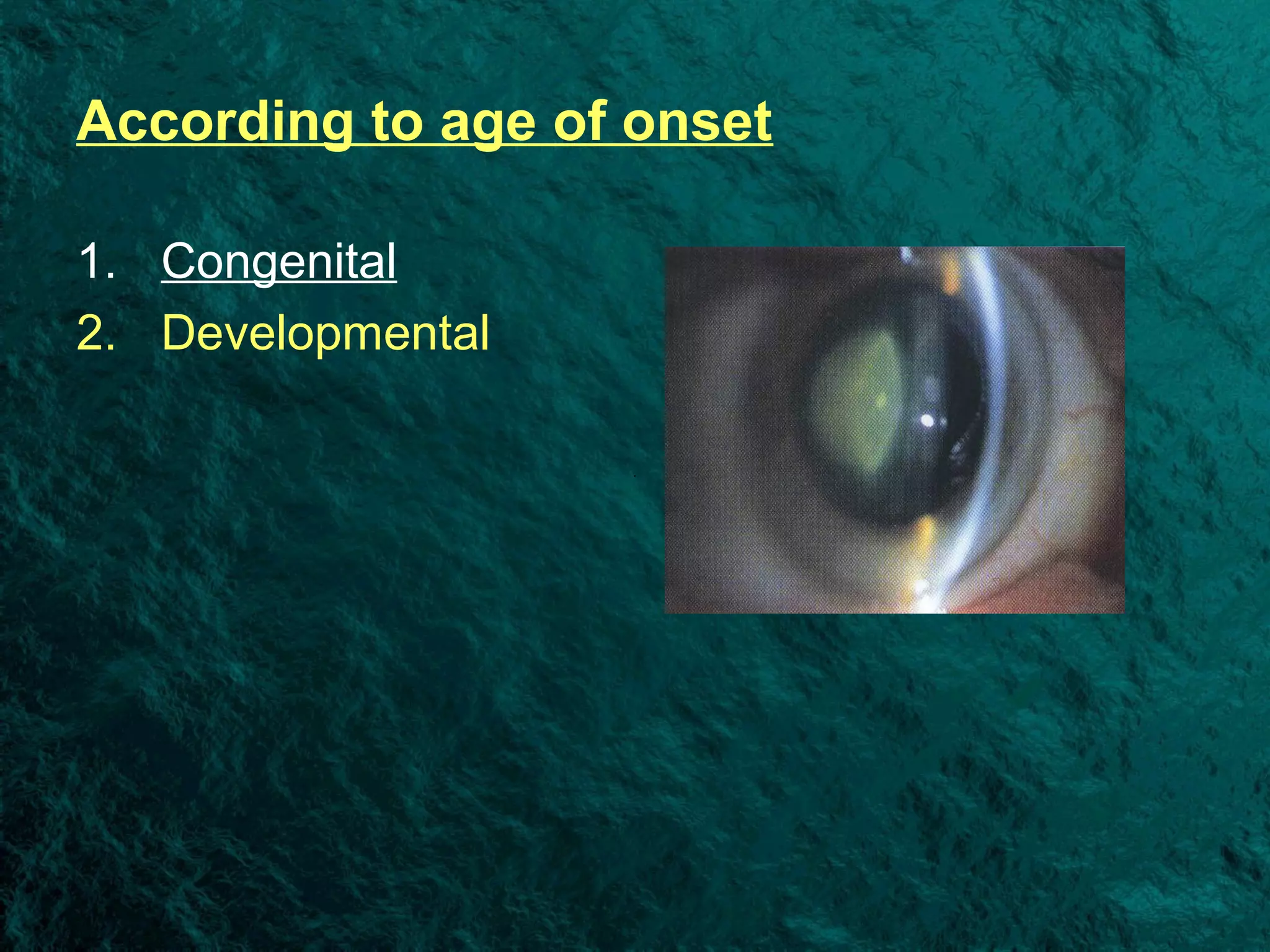 Congenital cataract | PPT