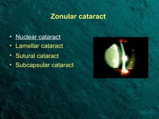 Congenital cataract | PPT