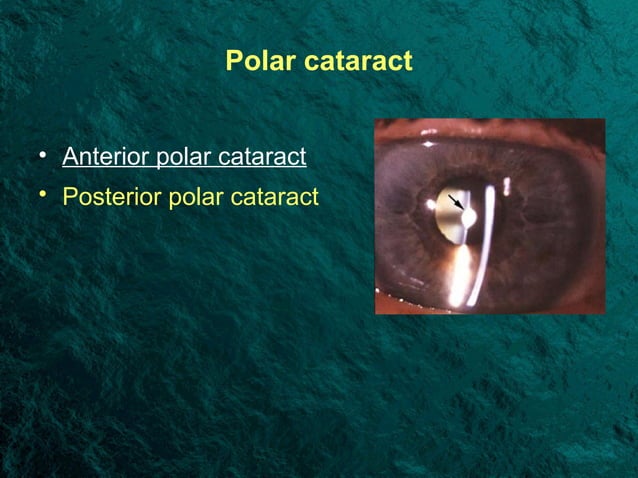 Congenital cataract | PPT