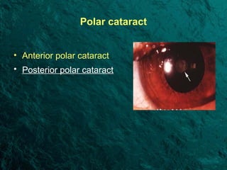 Congenital cataract | PPT