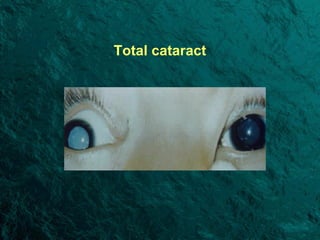 Congenital cataract | PPT