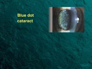 Congenital cataract | PPT