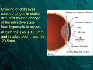 Congenital cataract | PPT