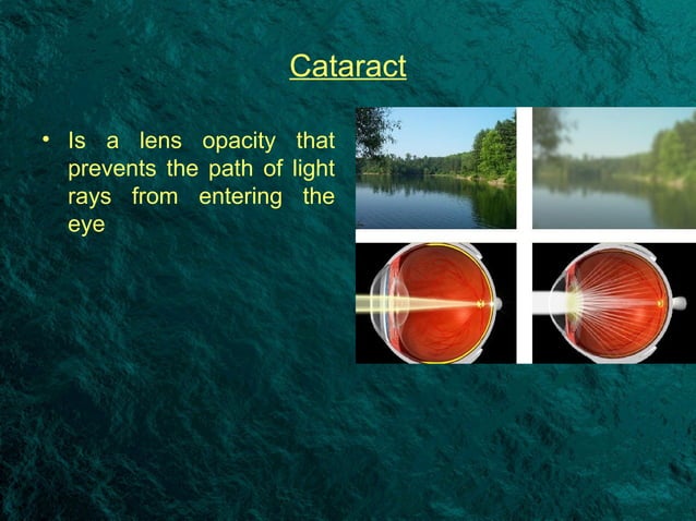 Congenital cataract | PPT