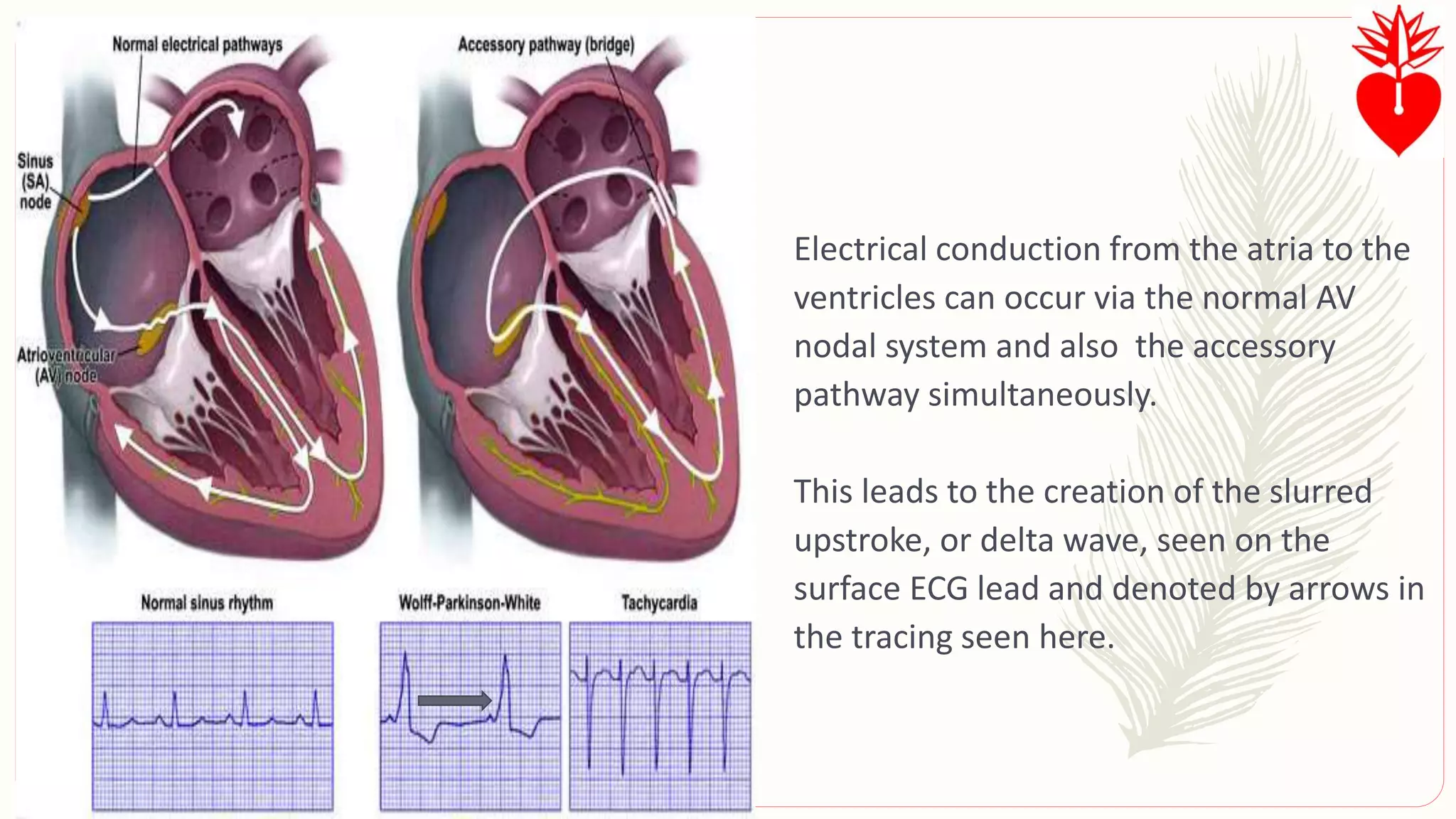 Wolf Parkinson Syndrome By Dr Hasan Mahmud. | PPTX