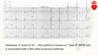 Wolf Parkinson Syndrome By Dr Hasan Mahmud. | PPTX