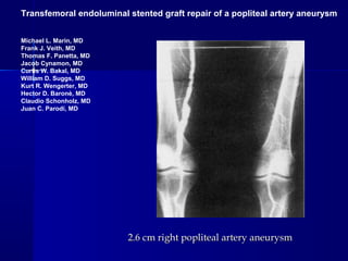 Dr Hiranya A. Rajasinghe - Popliteal Artery Aneurysms | PPT