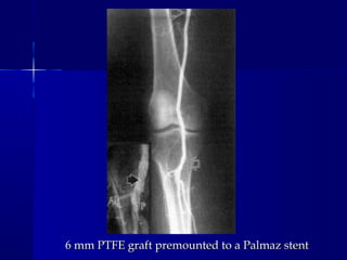 Dr Hiranya A. Rajasinghe - Popliteal Artery Aneurysms | PPT