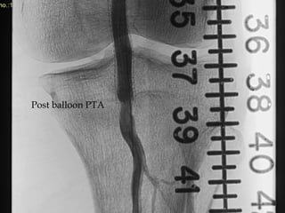 Dr Hiranya A. Rajasinghe - Popliteal Artery Aneurysms | PPT