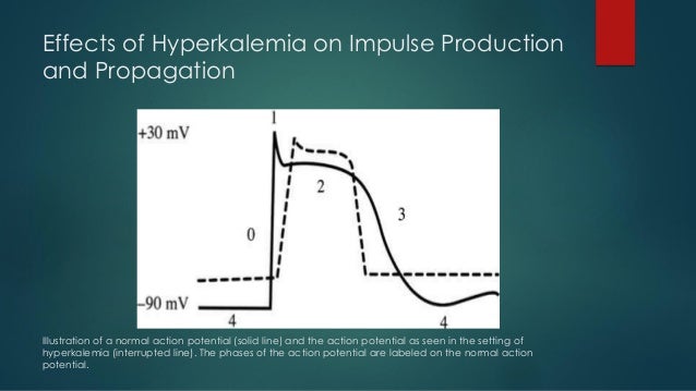 Hyperkalemia
