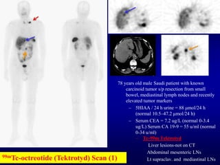 Octreotide Scan
