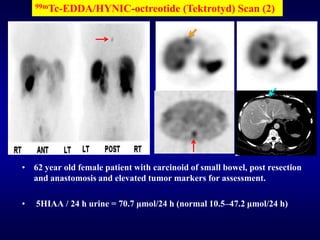 Octreotide Scan