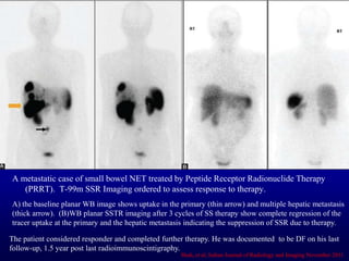 Octreotide Scan