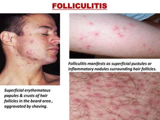 Dr hussein, bacterial infec of the skin | PPT