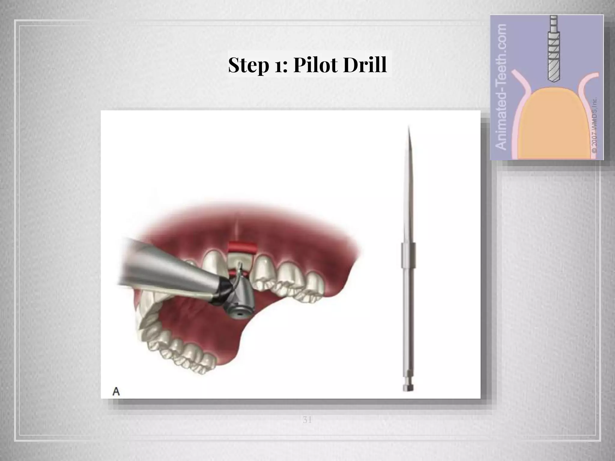 Drilling sequence in implants | PPTX