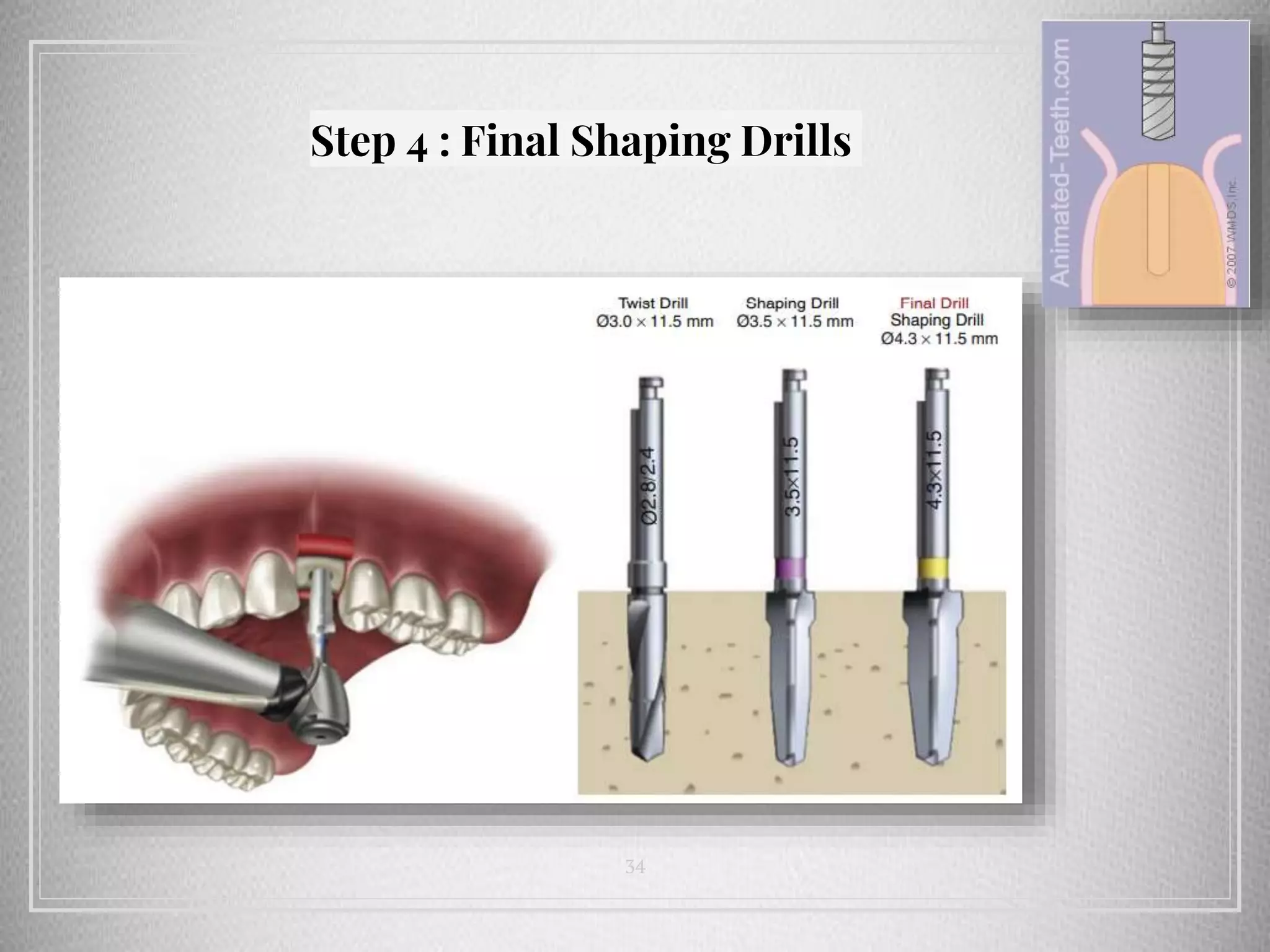 Drilling sequence in implants | PPTX