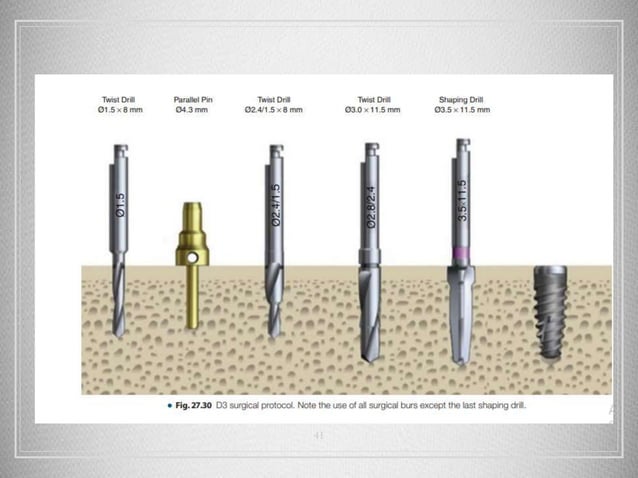 Drilling sequence in implants