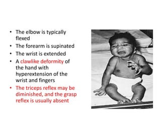 Dr kanij erbs palsy presentation | PPTX