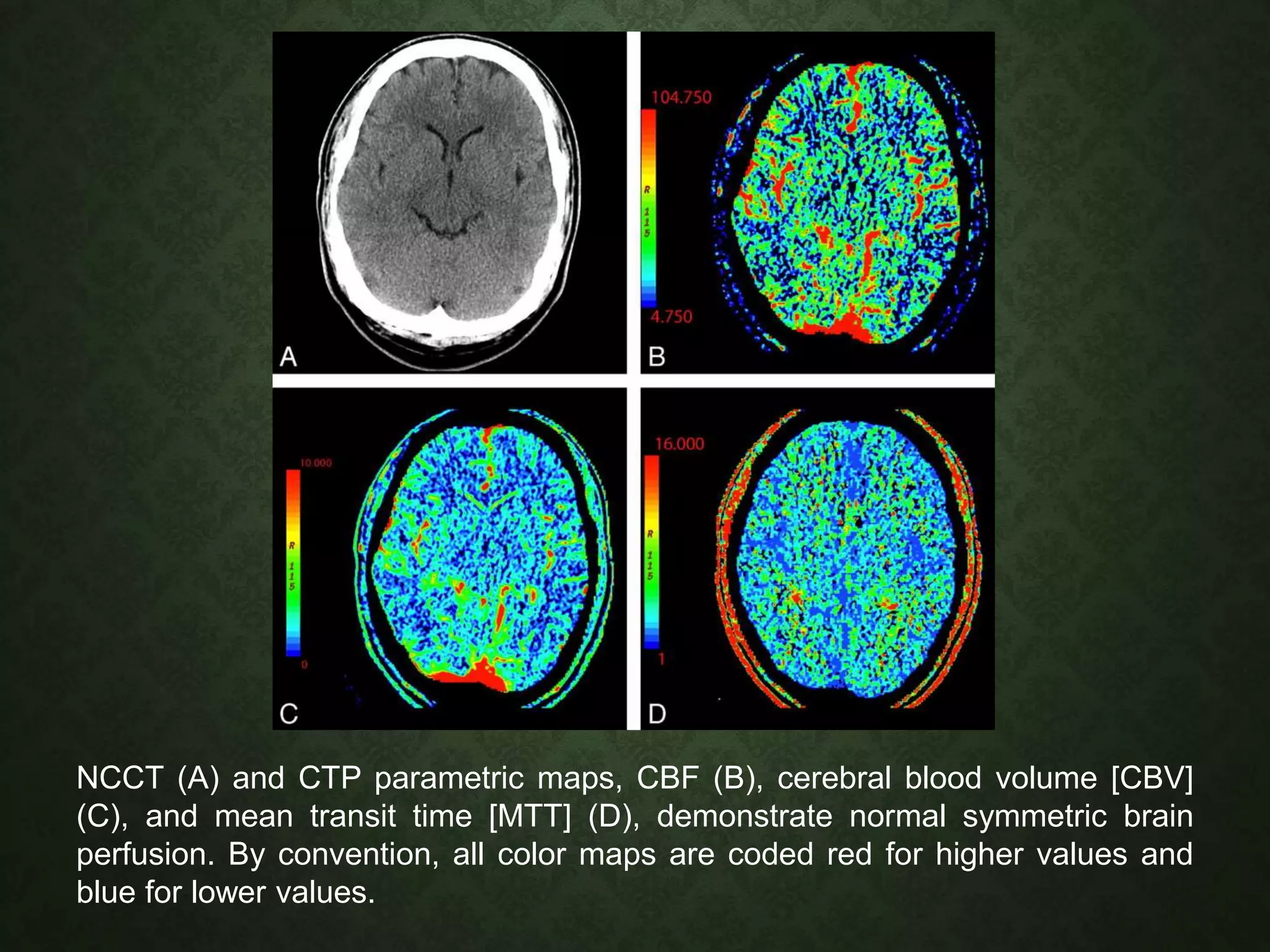 Measurement of Cerebral Blood Flow | PPTX