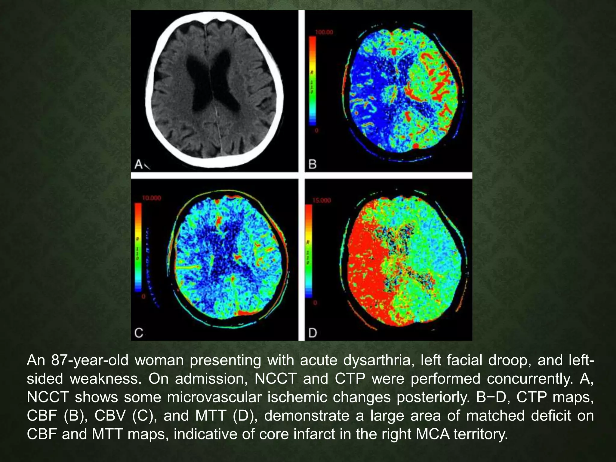 Measurement of Cerebral Blood Flow | PPTX
