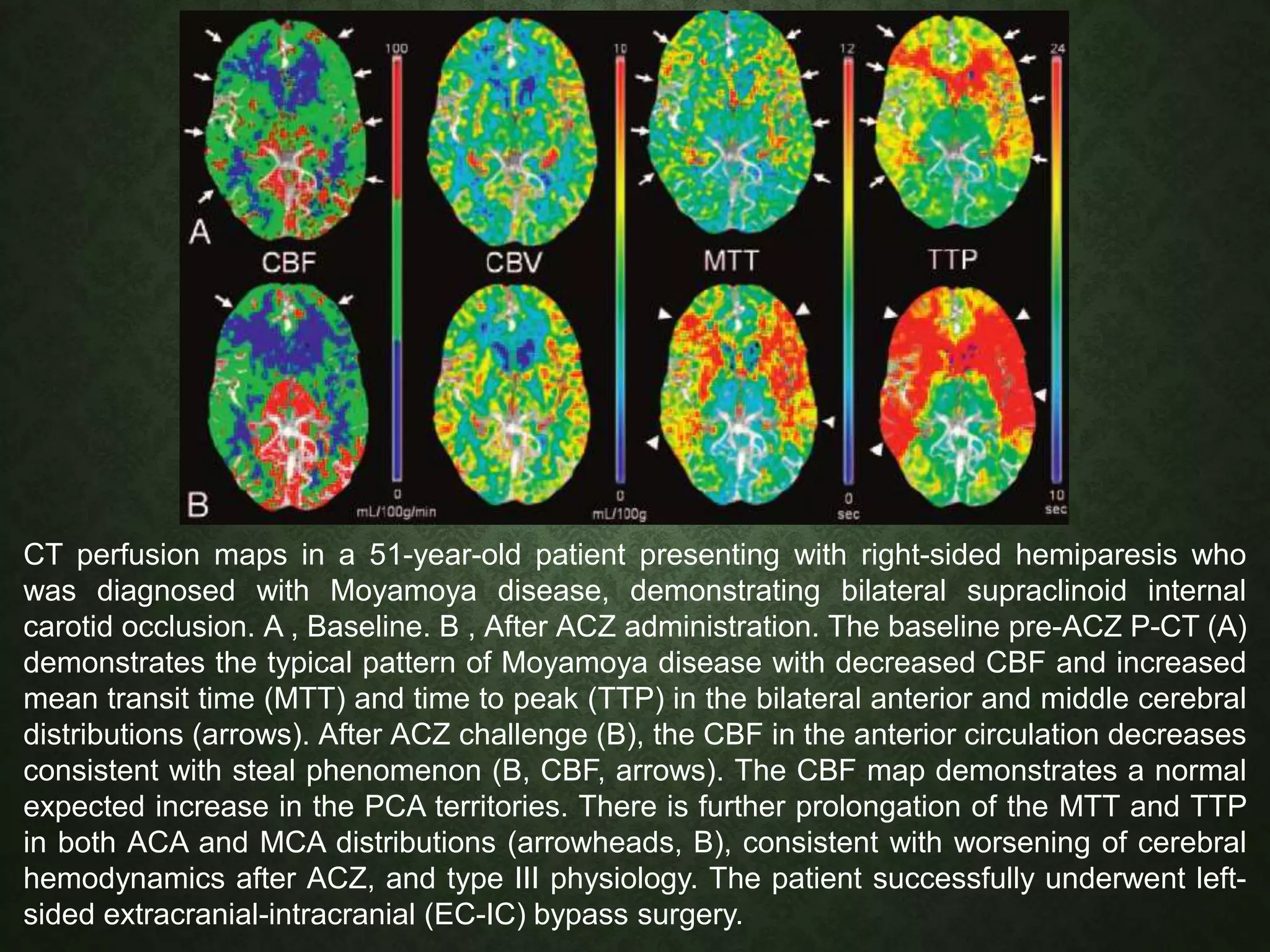 Measurement of Cerebral Blood Flow | PPTX