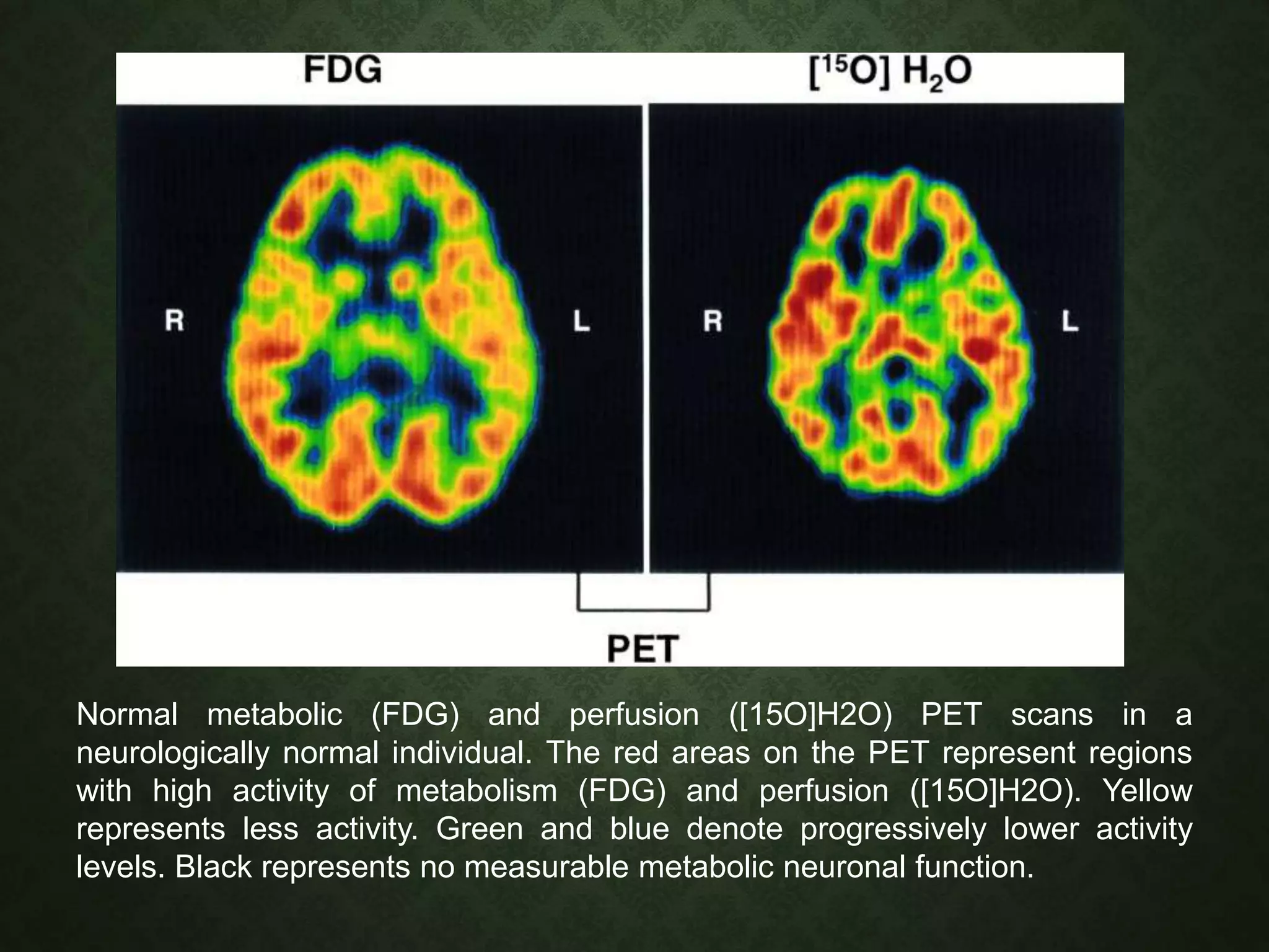 Measurement of Cerebral Blood Flow | PPTX