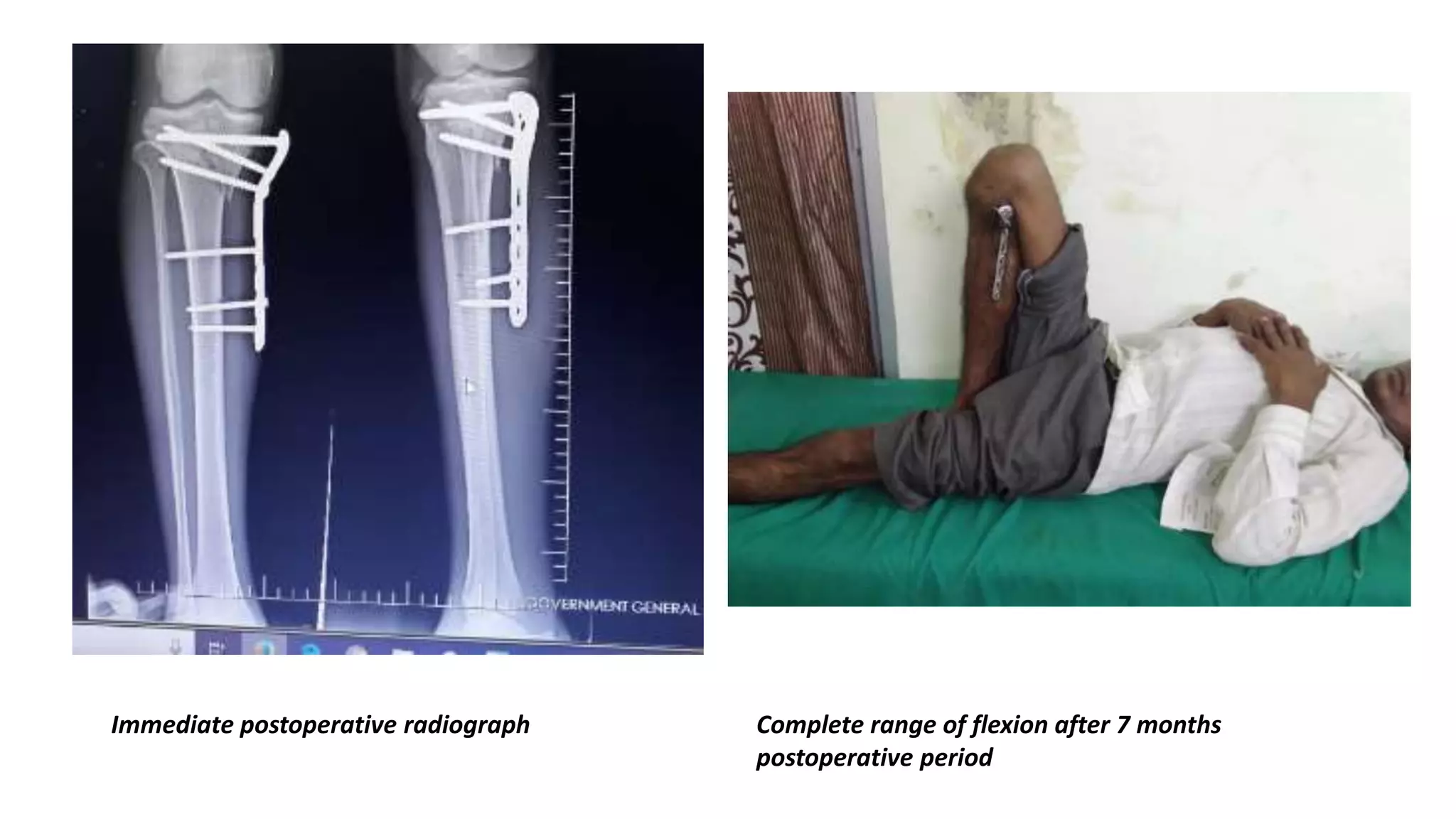 role of external locking plate in stabilizing compound tibia fractures ...