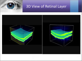 Optical/ocular coherence tomography OCT All in one Presentation | PPTX