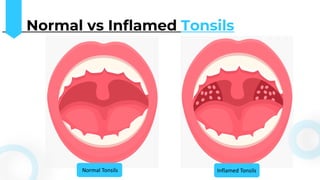 Understanding Tonsillitis by Dr. Brett Leavers | PPT