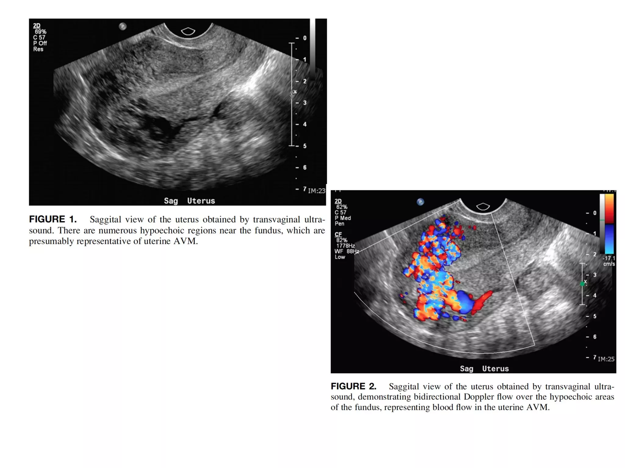 Uterine arteriovenous malformation Acquired Dr Mamta Lekhi | PPT