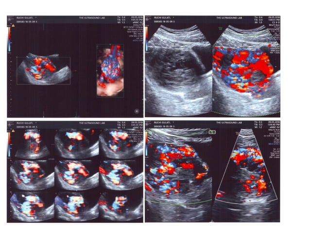 Uterine arteriovenous malformation Acquired Dr Mamta Lekhi | PPT ...