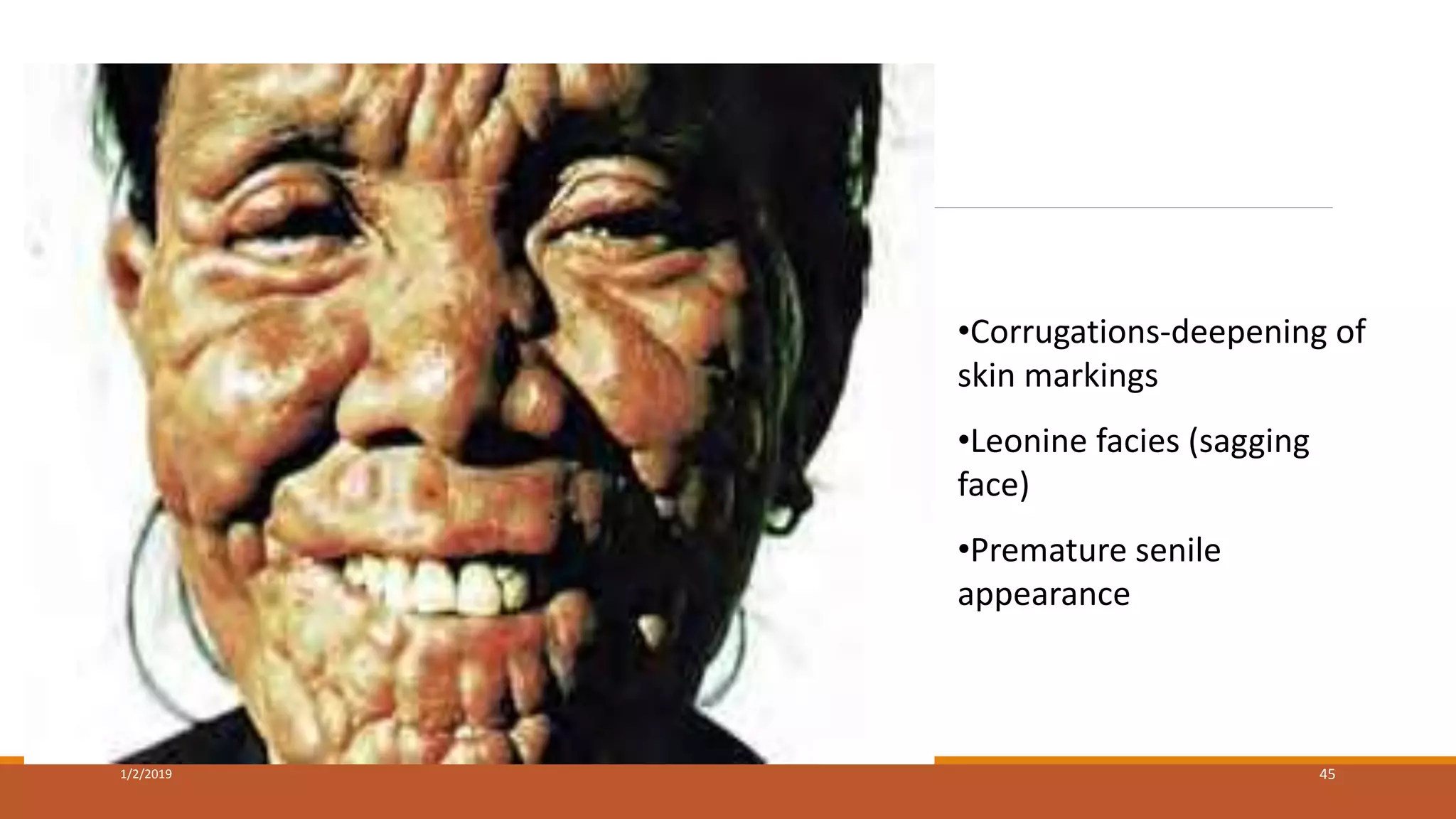 Deformities in leprosy Dr Manasa Shettisara Janney | PPTX | Death ...