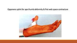 Deformities in leprosy Dr Manasa Shettisara Janney | PPTX