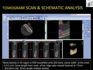 Mandibular reconstruction with Biohorizon System | PPT