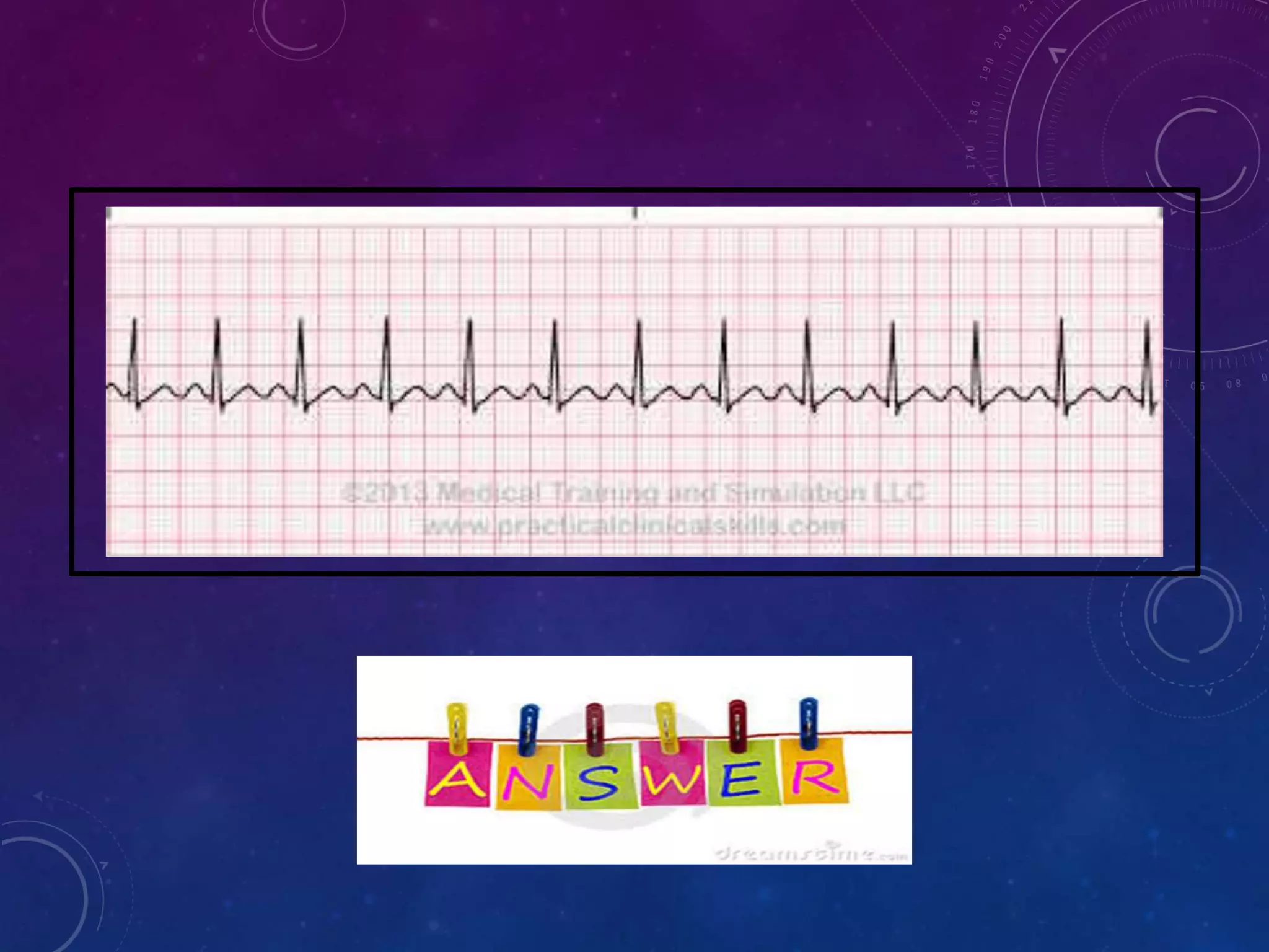 ACLS EKG quiz | PPT