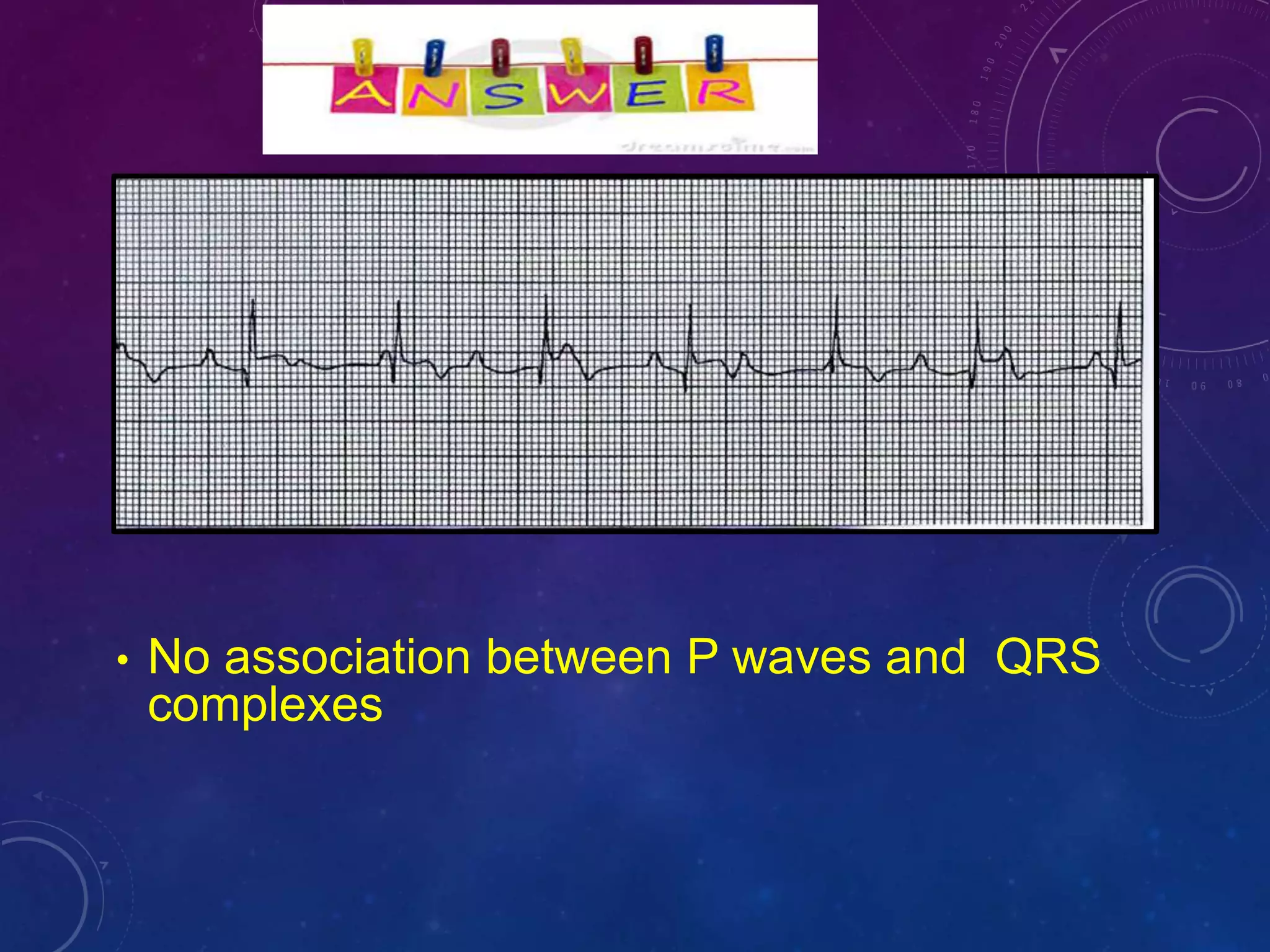 ACLS EKG quiz | PPT