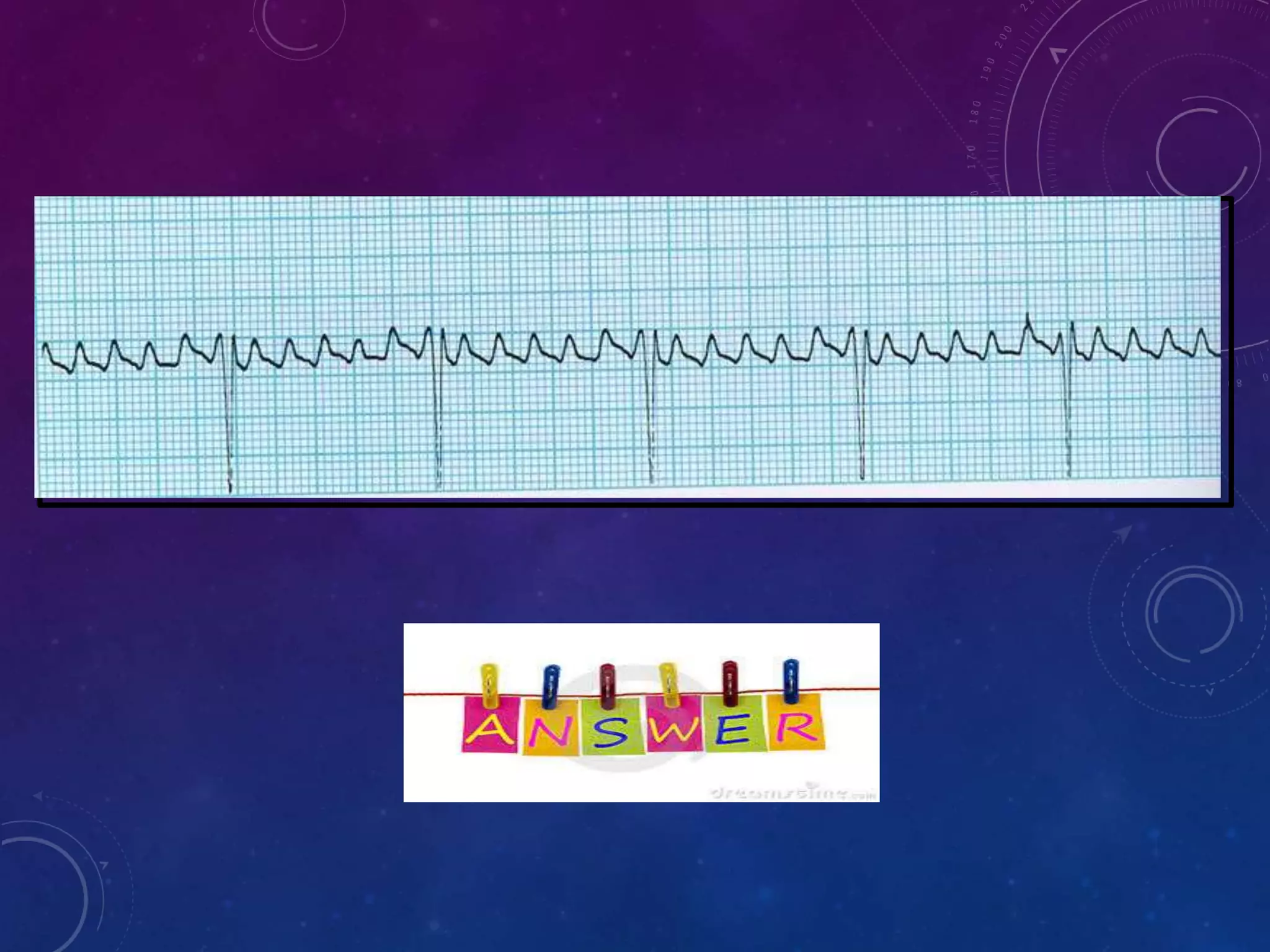 ACLS EKG quiz | PPT