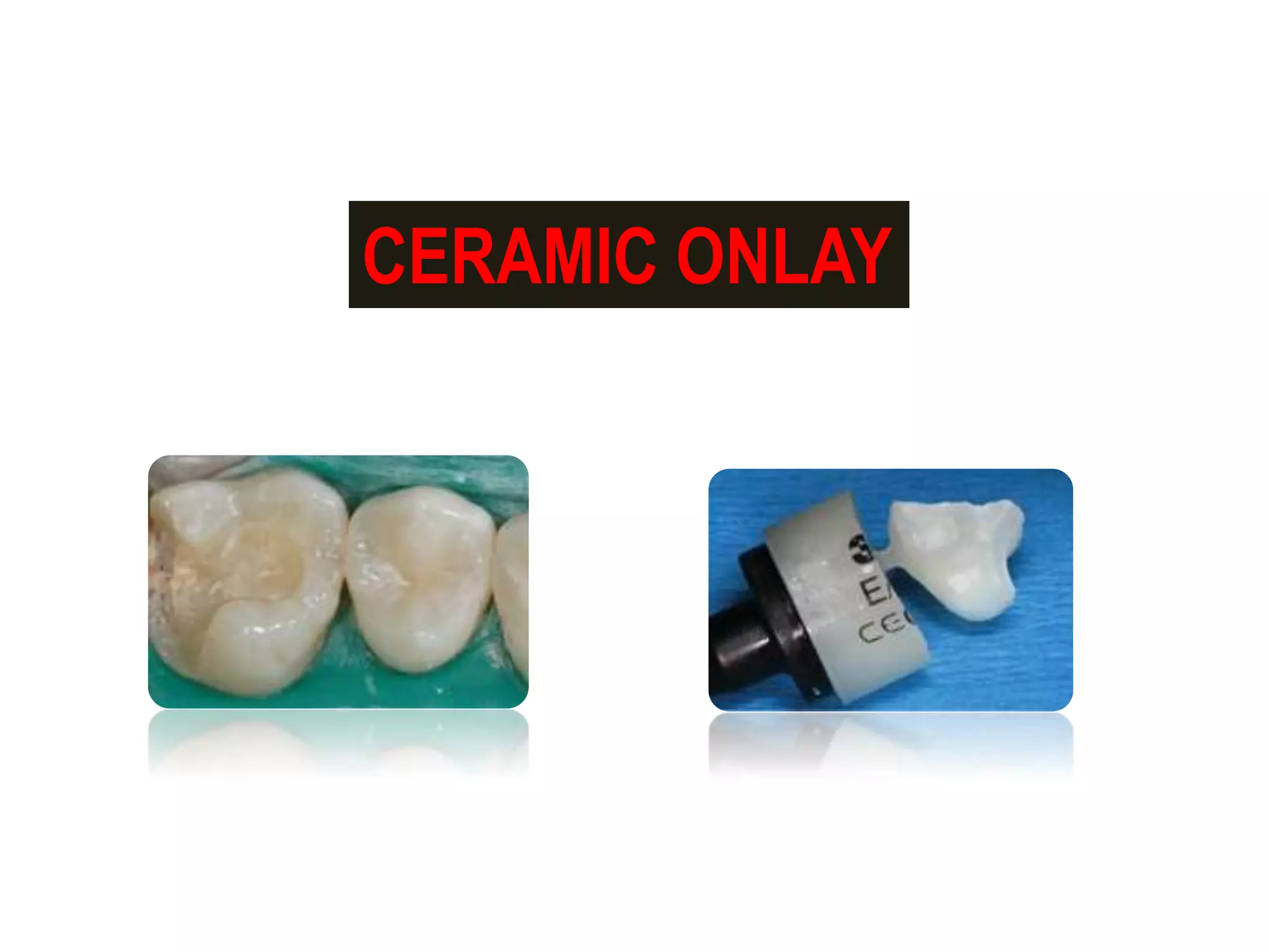 APPLICATIONS OF CERAMICS IN DENTISTRY - Dr MEENU MERRY C PAUL | PPTX