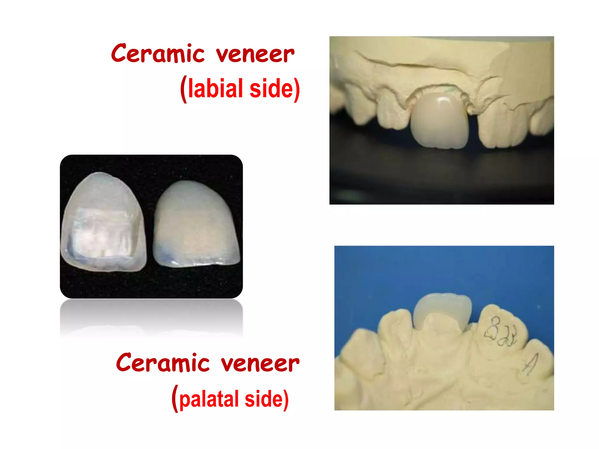 APPLICATIONS OF CERAMICS IN DENTISTRY - Dr MEENU MERRY C PAUL | PPTX