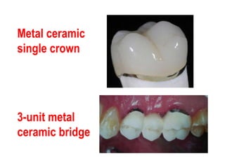 APPLICATIONS OF CERAMICS IN DENTISTRY - Dr MEENU MERRY C PAUL | PPTX
