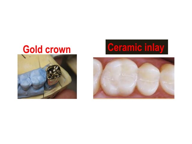 APPLICATIONS OF CERAMICS IN DENTISTRY - Dr MEENU MERRY C PAUL | PPTX ...