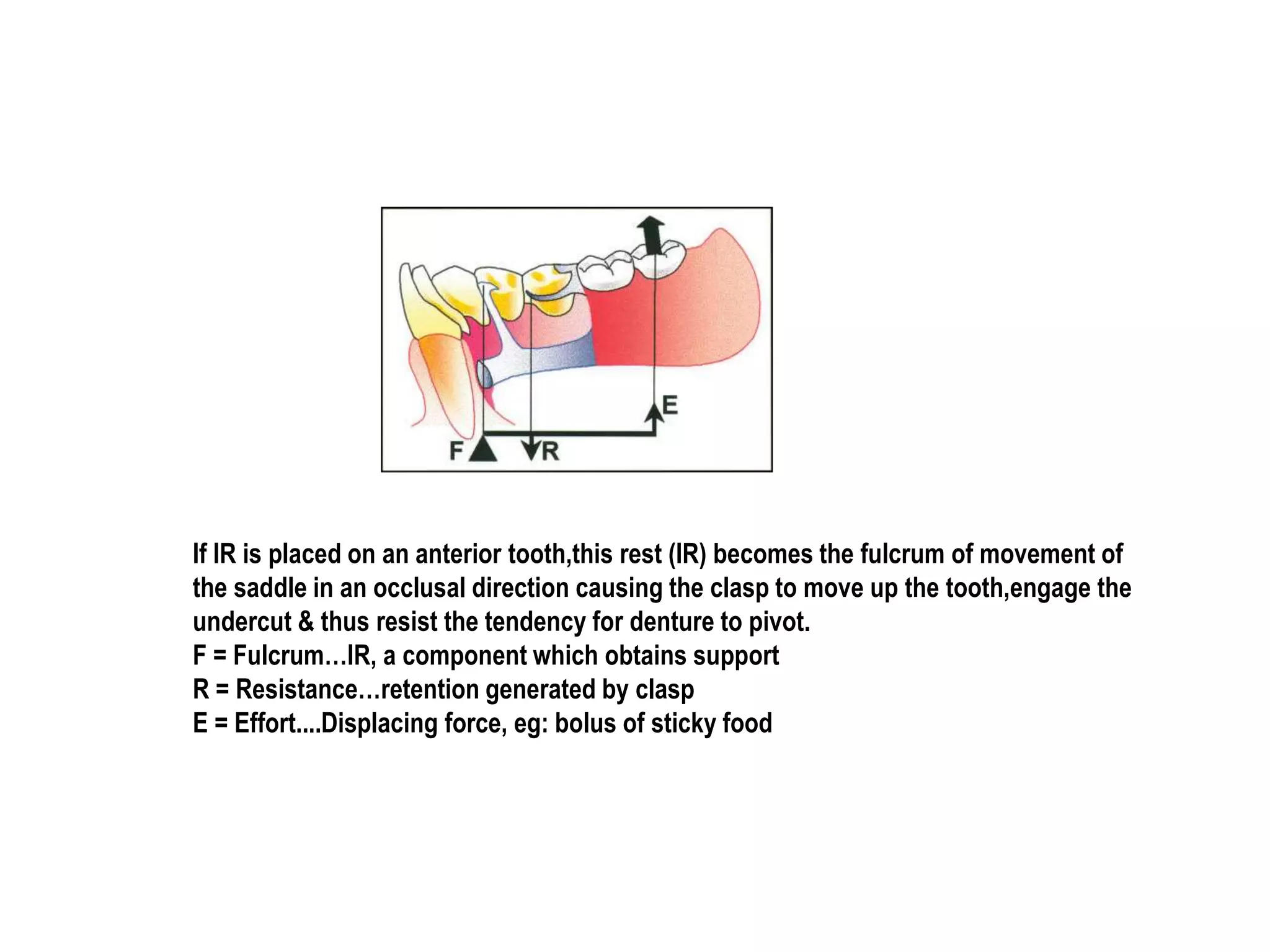 INDIRECT RETAINERS IN CAST PARTIAL DENTURES- Dr MEENU MERRY C PAUL | PPTX