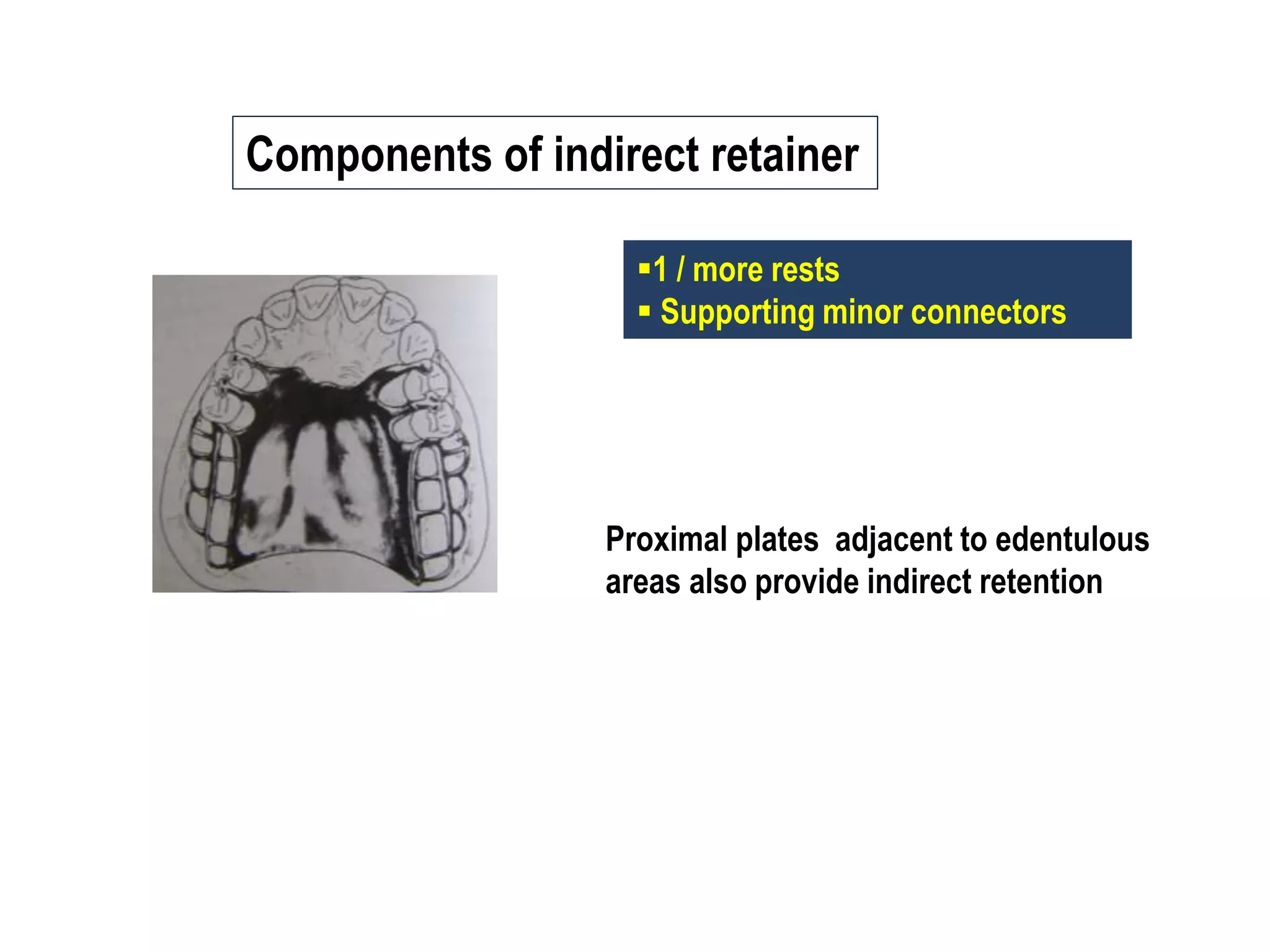 INDIRECT RETAINERS IN CAST PARTIAL DENTURES- Dr MEENU MERRY C PAUL | PPTX