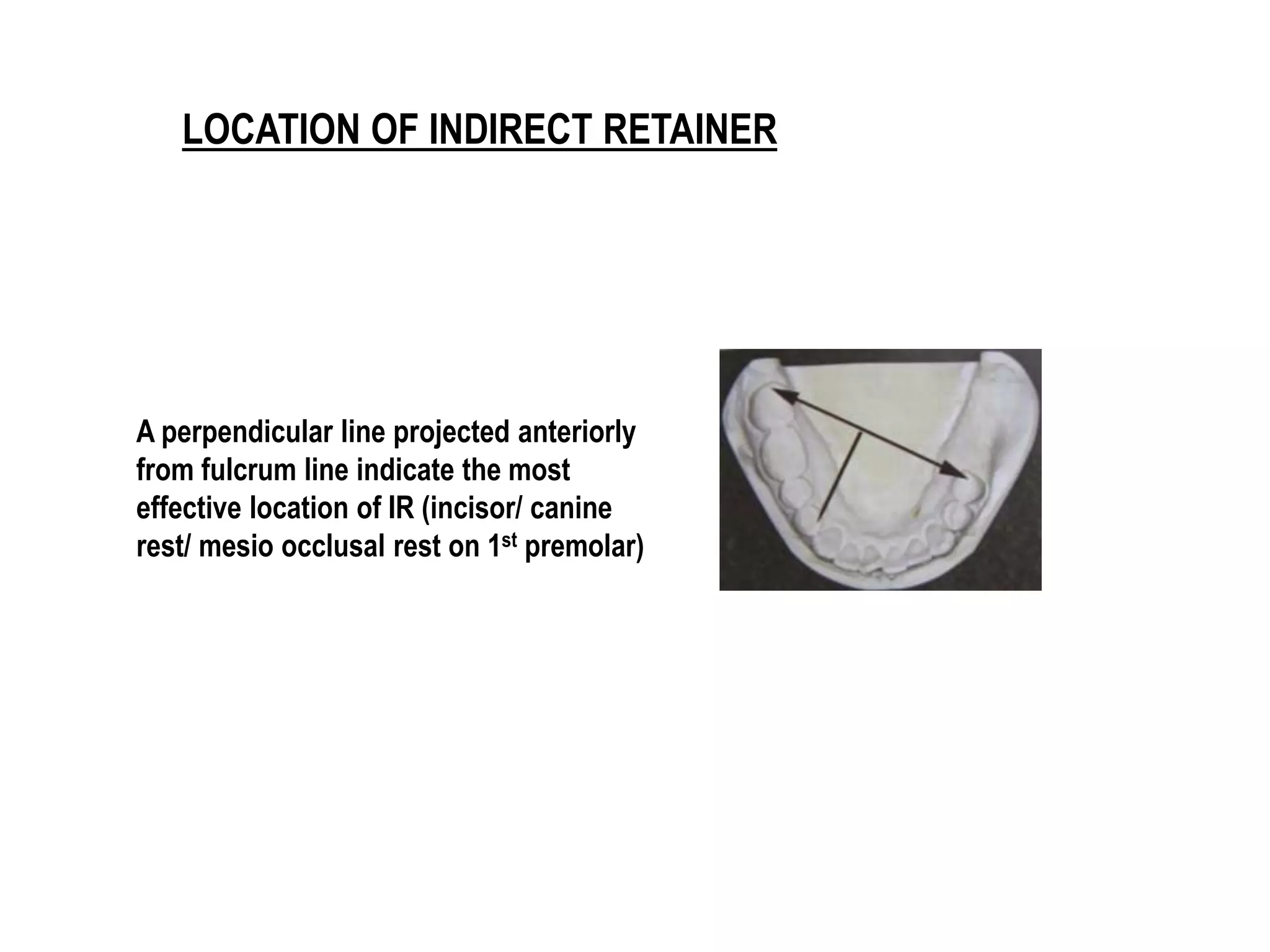 INDIRECT RETAINERS IN CAST PARTIAL DENTURES- Dr MEENU MERRY C PAUL | PPTX