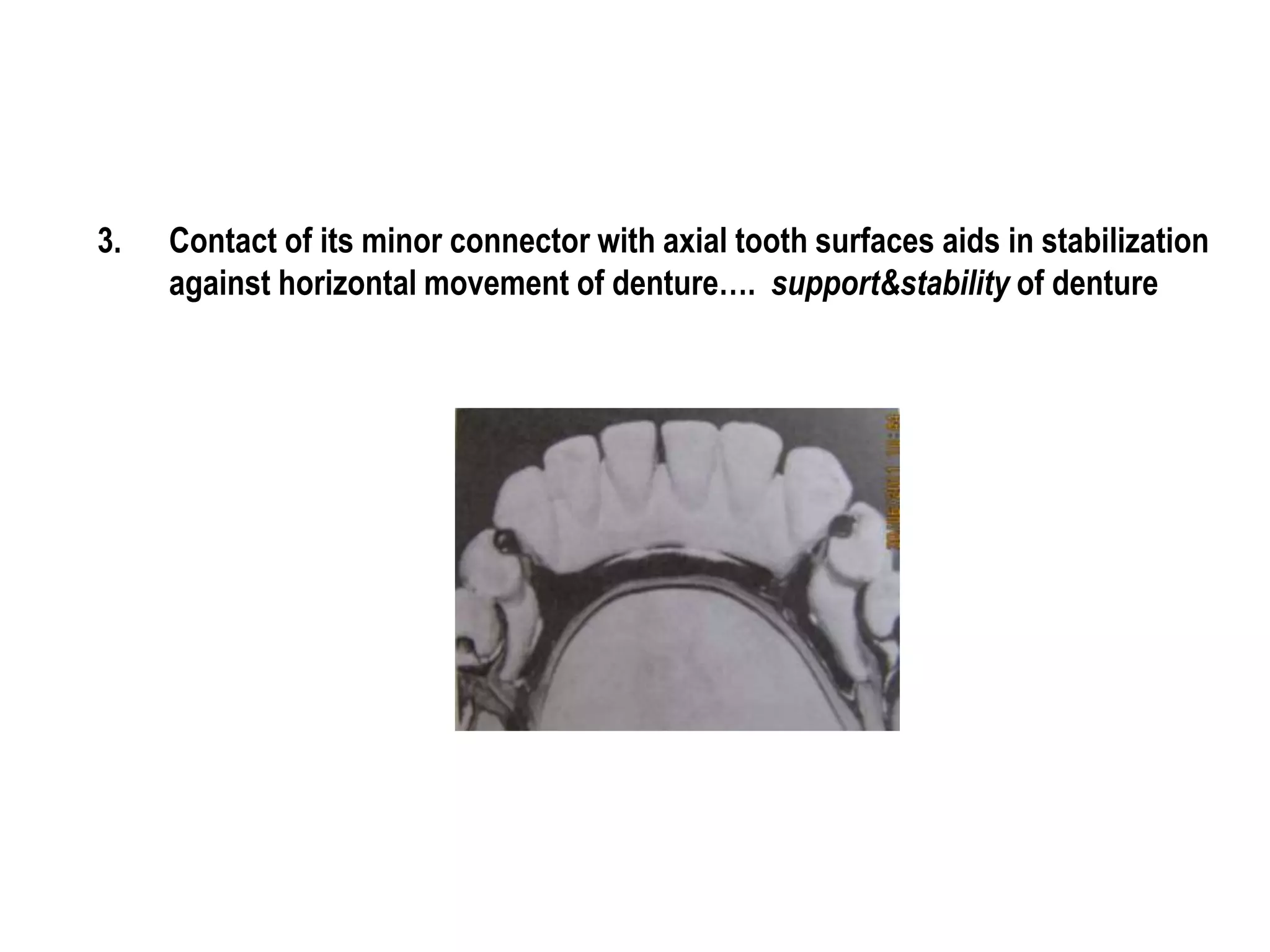 INDIRECT RETAINERS IN CAST PARTIAL DENTURES- Dr MEENU MERRY C PAUL | PPTX