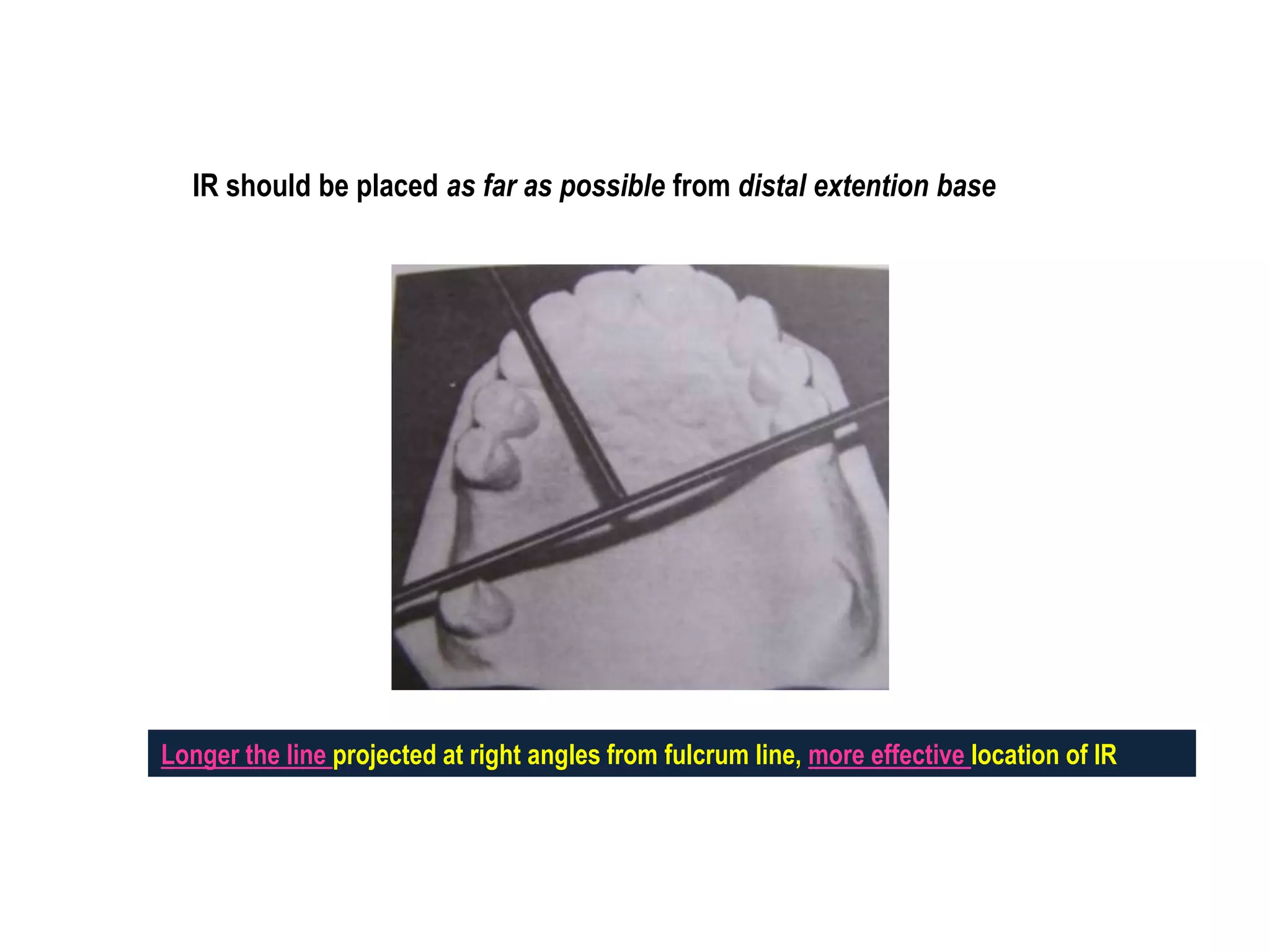 INDIRECT RETAINERS IN CAST PARTIAL DENTURES- Dr MEENU MERRY C PAUL | PPTX