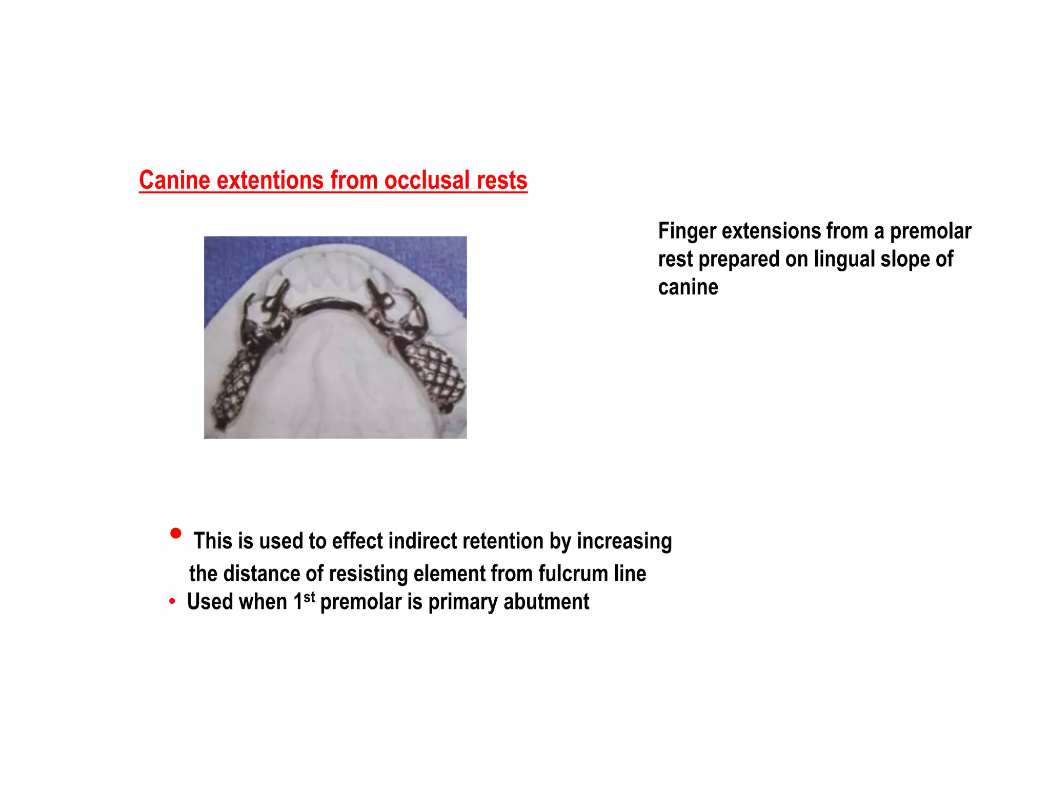 INDIRECT RETAINERS IN CAST PARTIAL DENTURES- Dr MEENU MERRY C PAUL | PPTX