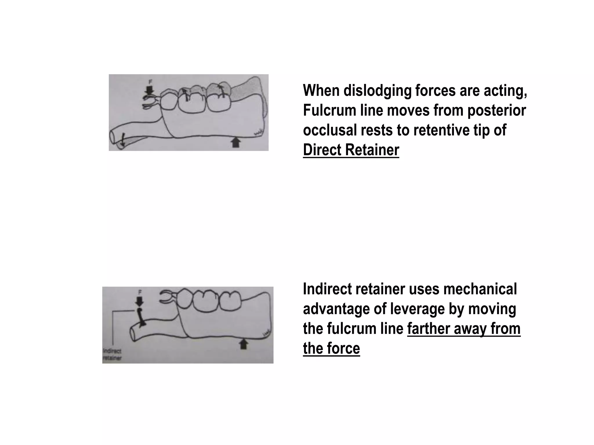 INDIRECT RETAINERS IN CAST PARTIAL DENTURES- Dr MEENU MERRY C PAUL | PPTX