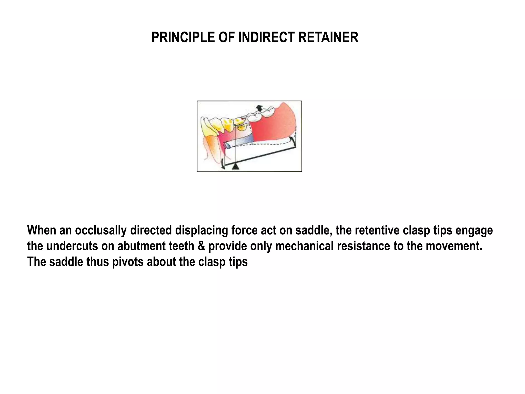 INDIRECT RETAINERS IN CAST PARTIAL DENTURES- Dr MEENU MERRY C PAUL | PPTX