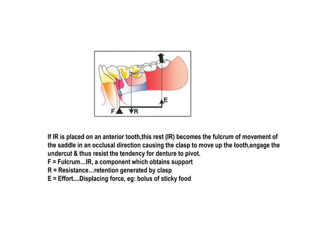 INDIRECT RETAINERS IN CAST PARTIAL DENTURES- Dr MEENU MERRY C PAUL | PPT
